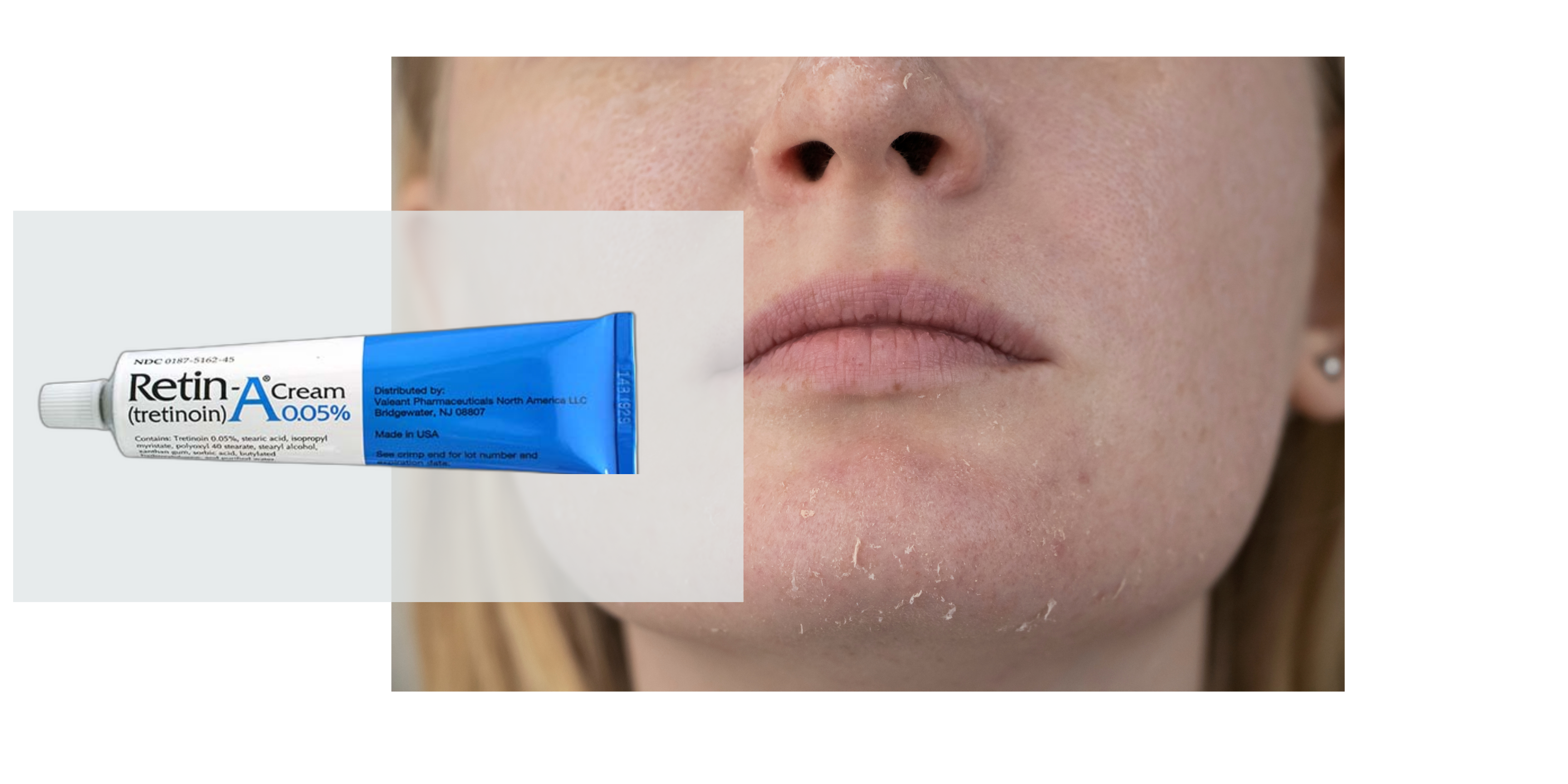 Retin A Before And After Acne