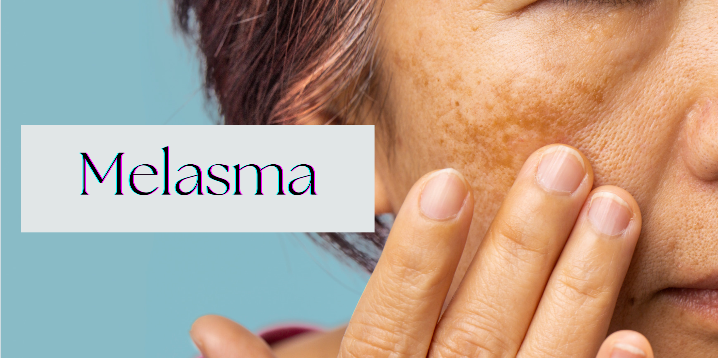 Understanding Melasma: Causes, Effects of Sun Exposure, and Effective ...